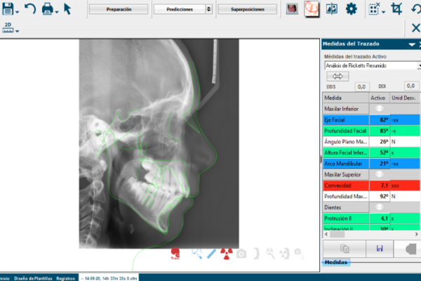 Análisis cefalométrico software NEMOCEPH - Marfilden